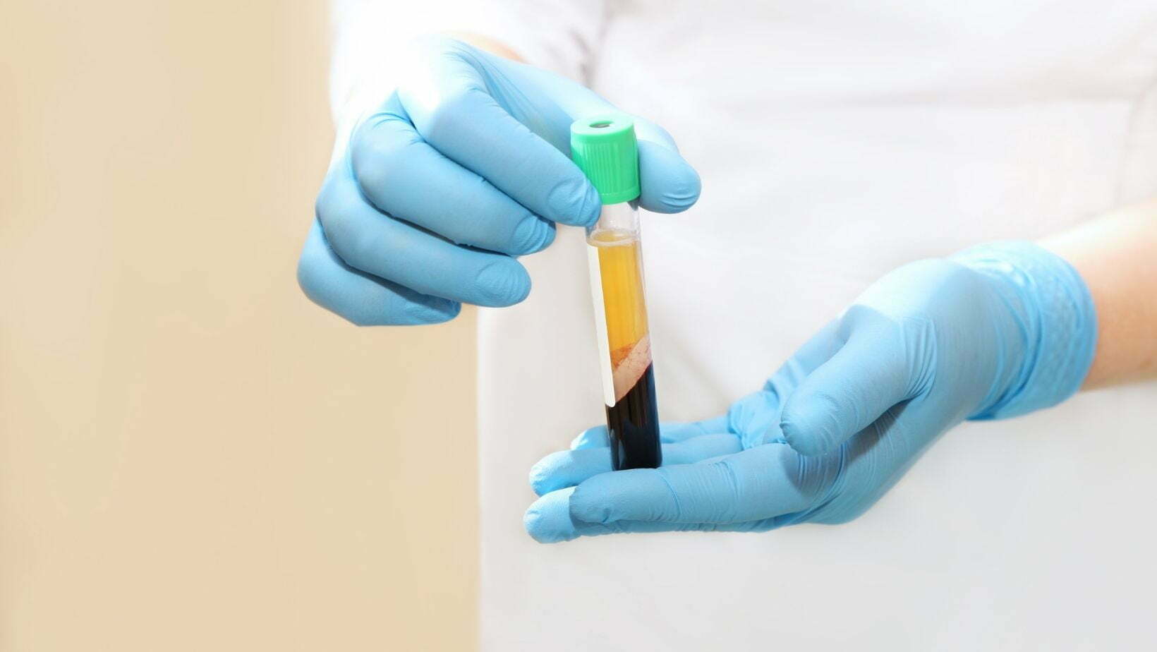 Platelet Rich Plasma Therapy - Sparsh Skin Clinic