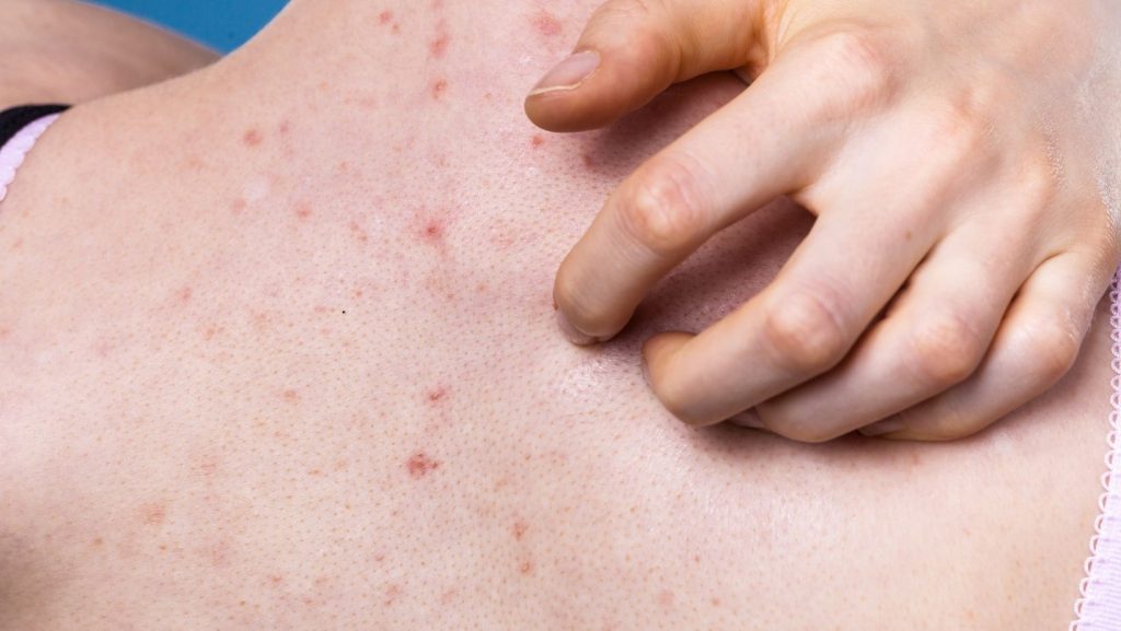 How To Treat Back Acne Treatment? - Sparsh Skin Clinic