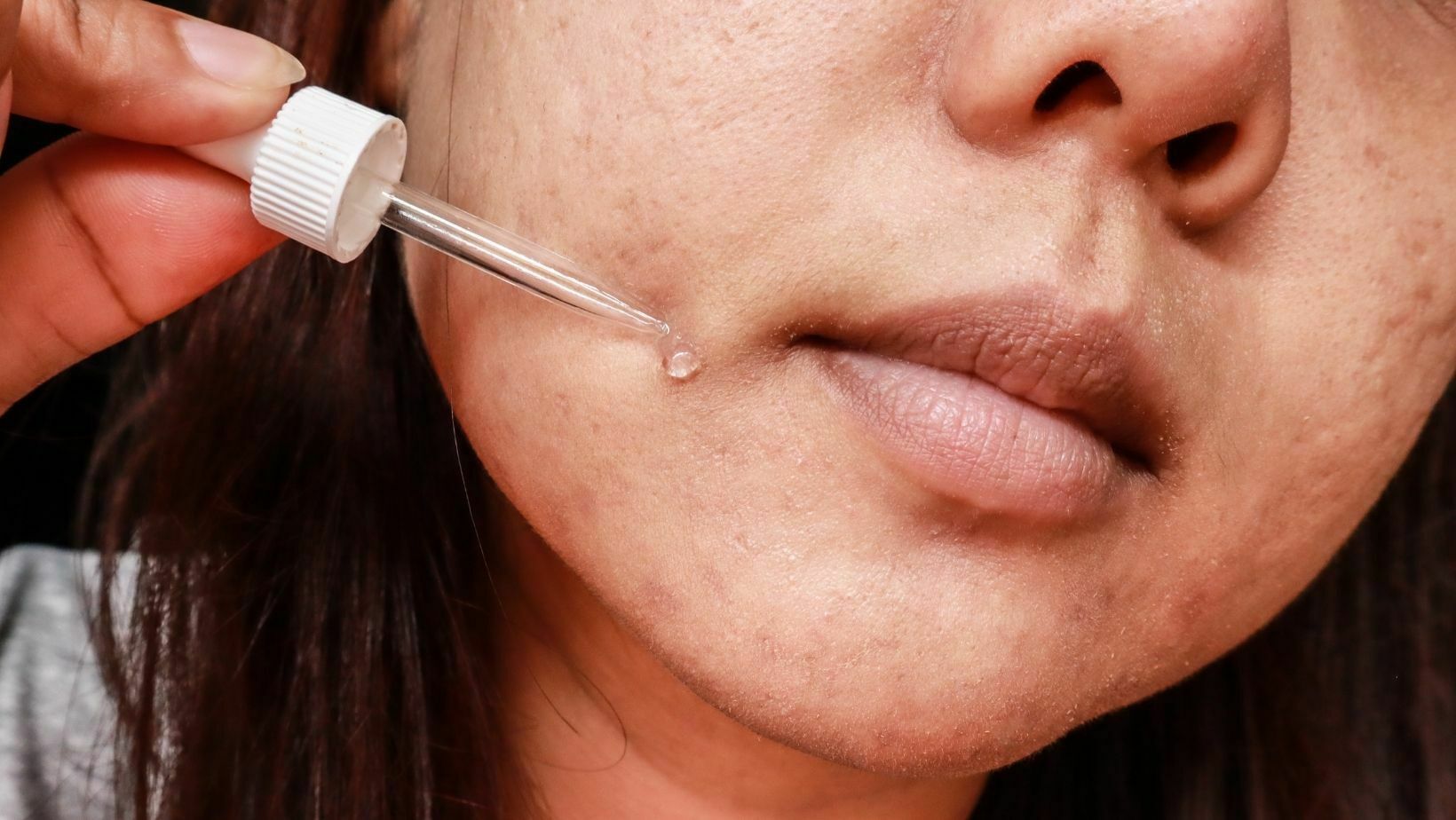 What Is the Best Treatment for Treating Melasma on Face? - Sparsh Skin ...