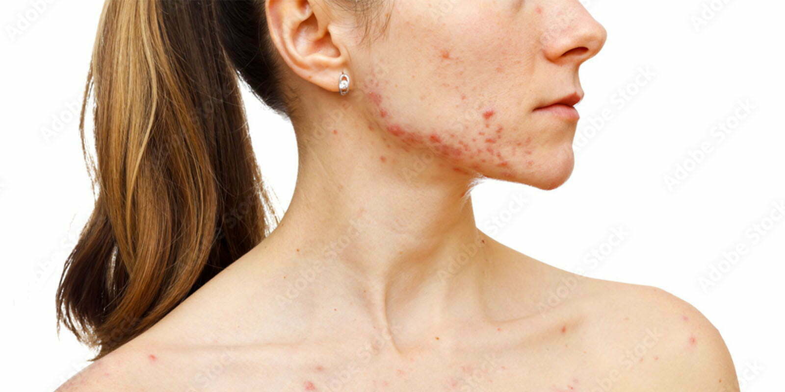 Skin Infections Treatment - Sparsh Skin Clinic