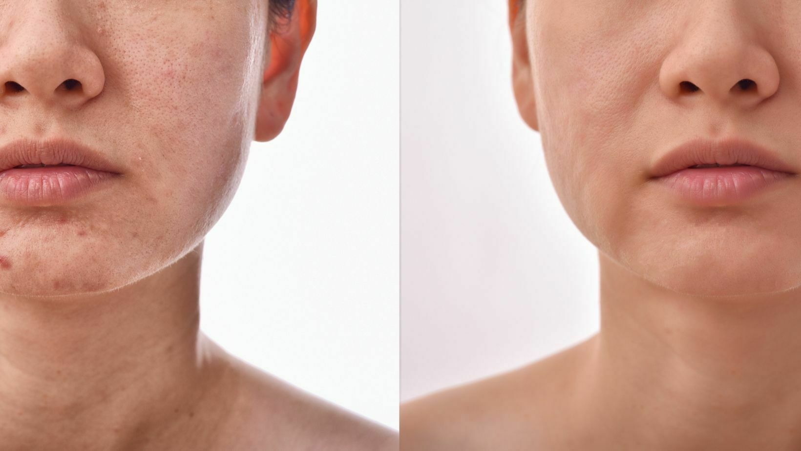 Profhilo Treatment v/s Volite Treatment versus other fillers - Sparsh ...