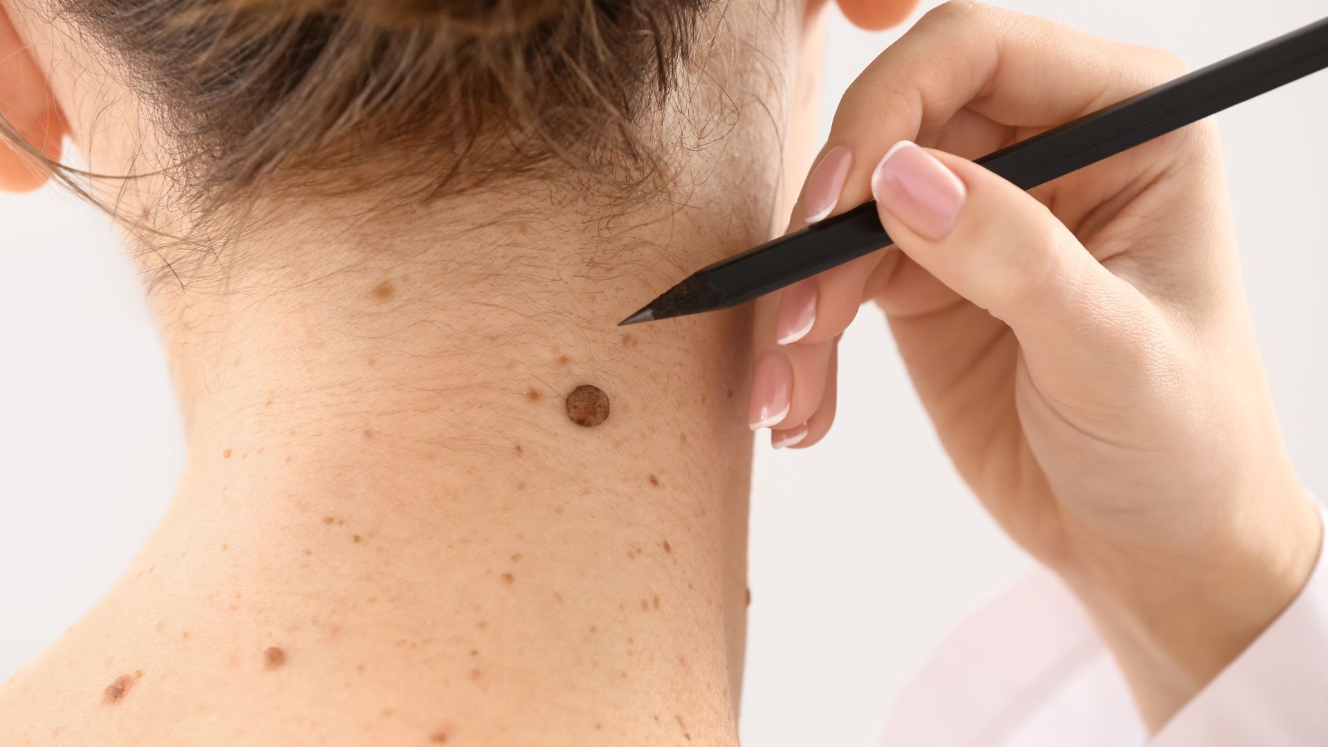 Mole Removal Aftercare Instructions - Sparsh Skin Clinic